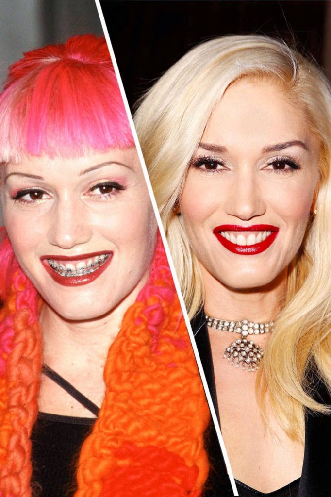 Look How Gwen Stefani’s Plastic Surgery has Helped Her Shift from ...
